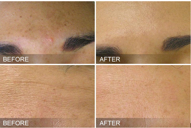 Θεραπεία Hydrafacial - Υδροδερμοαπόξεση | Κόστος | Bioiatriki+ DERMA